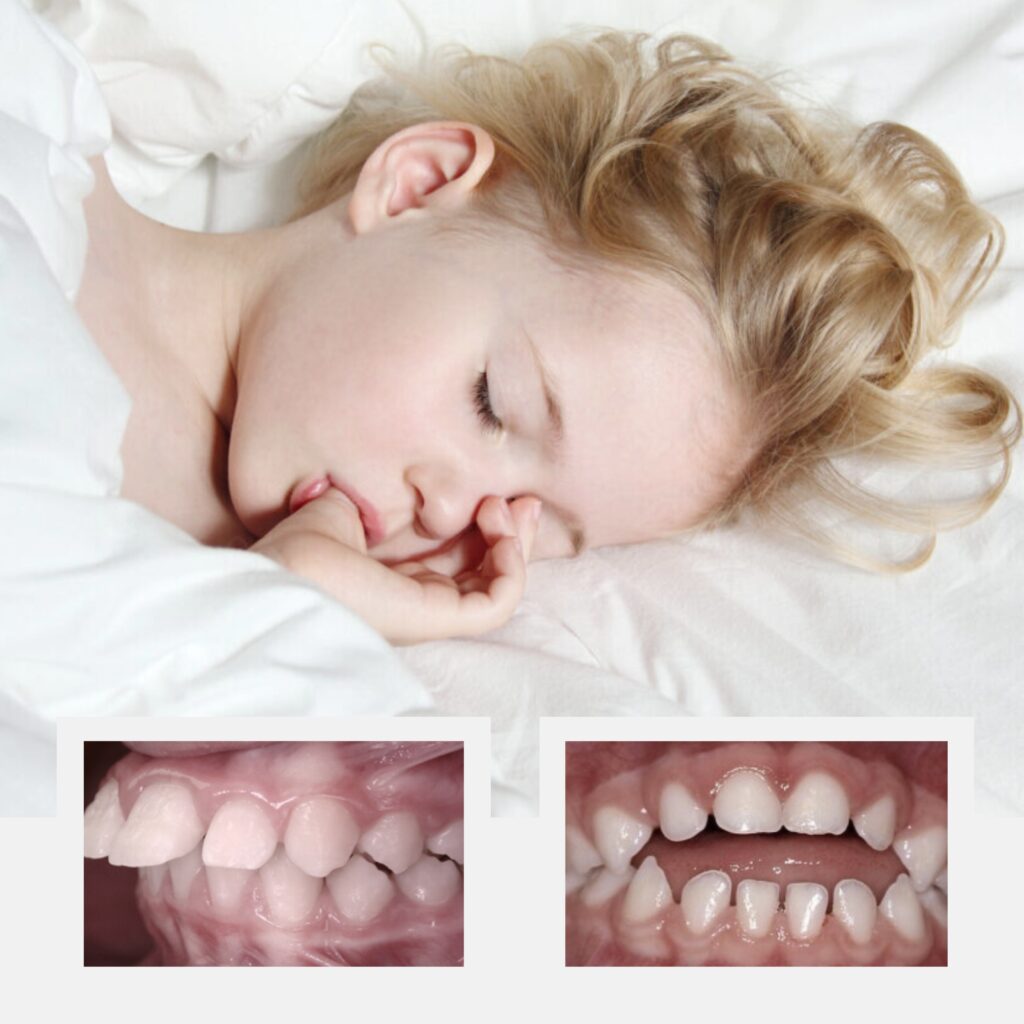 6 Tips to Prevent Mouth Breathing in Infants and Children | Family ...